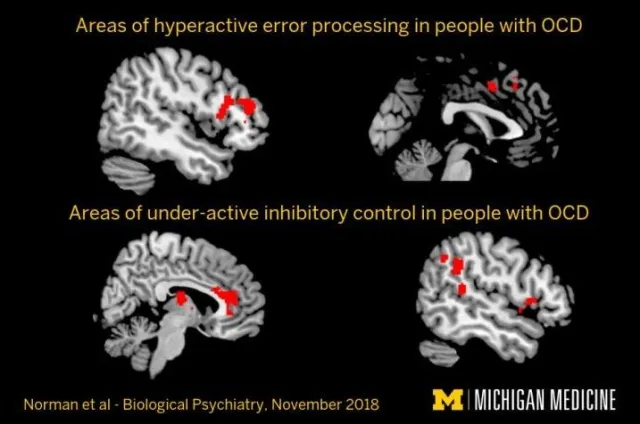 What Causes OCD?: Brain Scans Suggest Sufferers Have ‘Inefficient ...