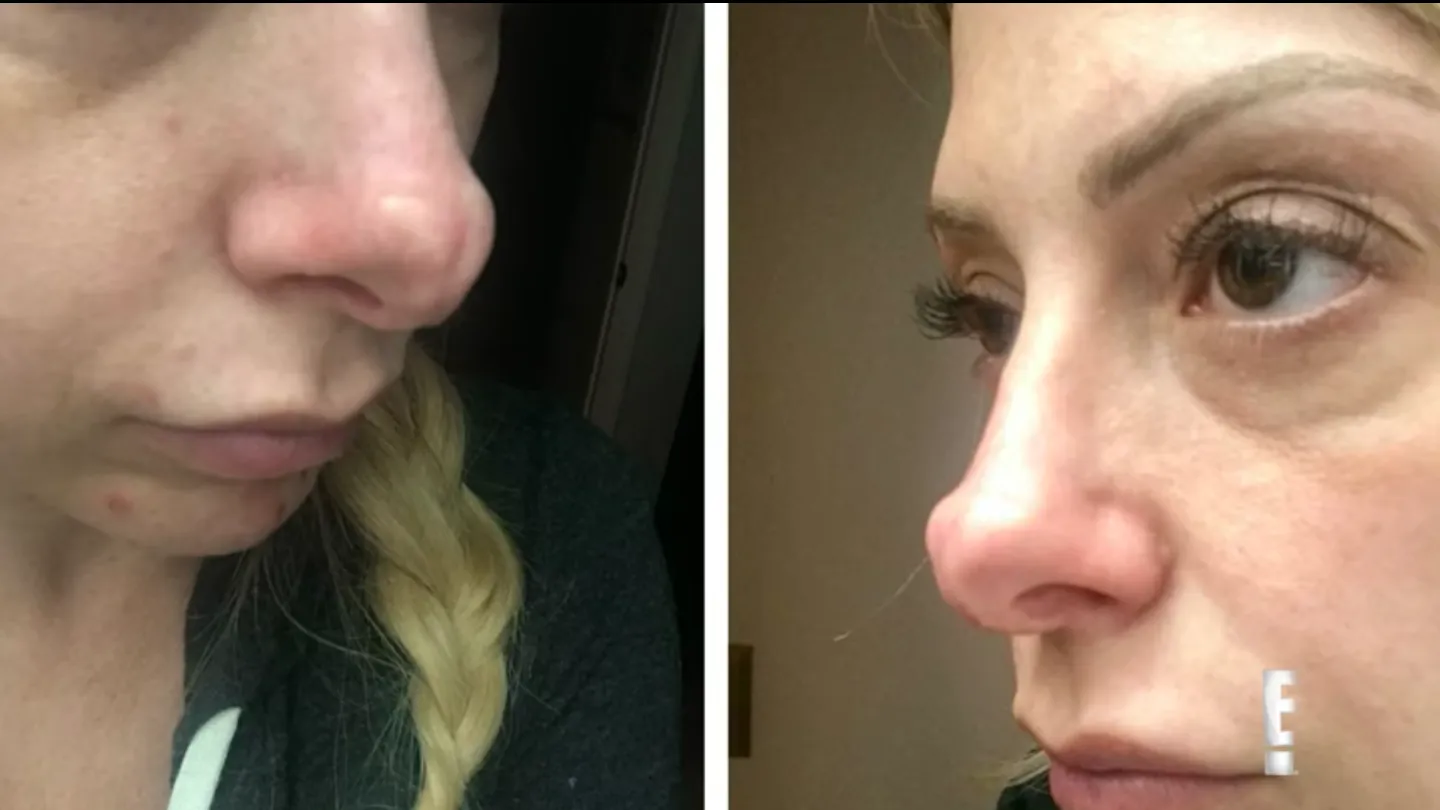Where Is ‘Botched’ Subject Jennifer Now? Update on Dr. Nassif’s Patient ...