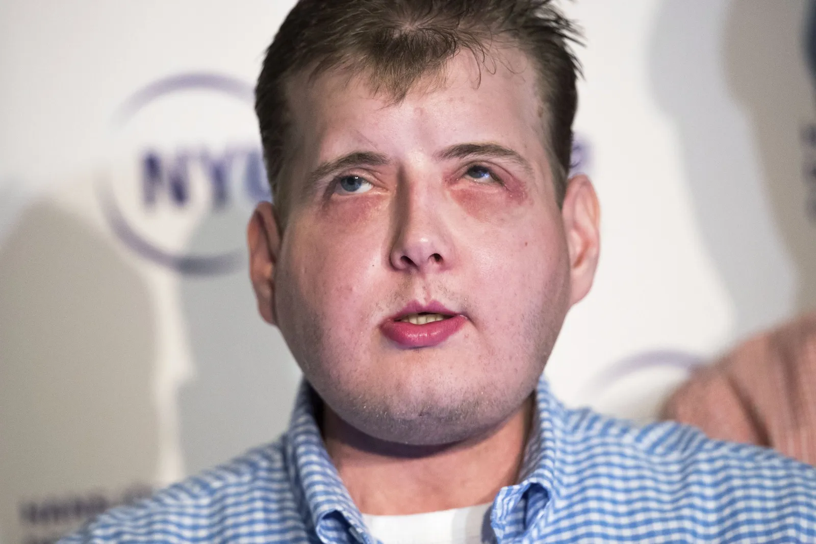 Facial Transplant Patients on Life After Surgery: I Had to Tell People ...