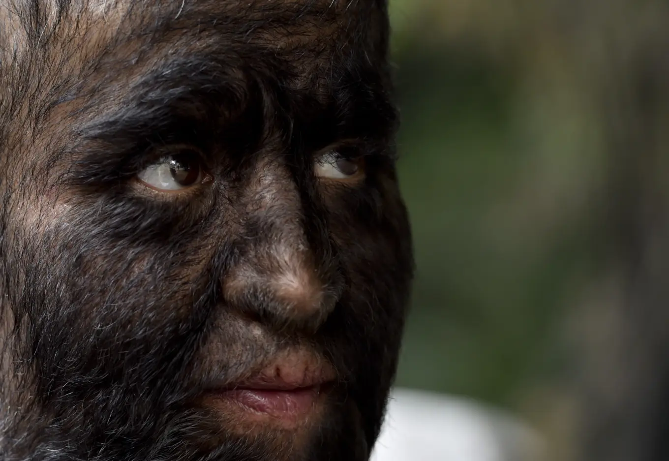 Babies Develop ‘Werewolf Syndrome’ after Taking Drugs Con... - Newsweek