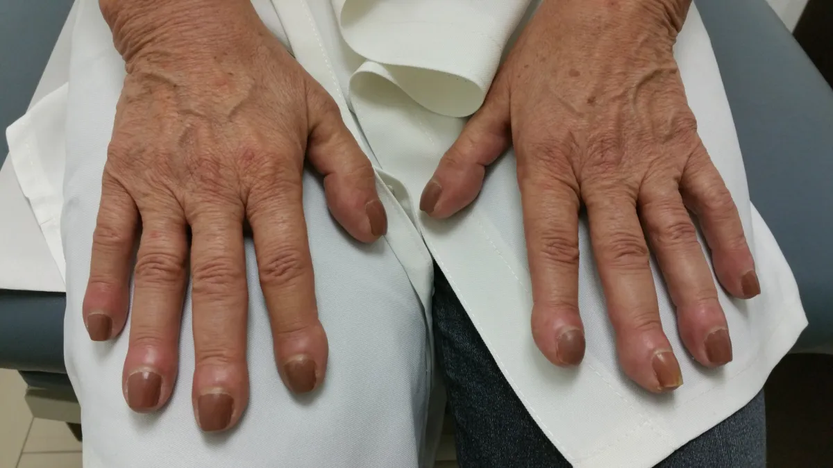 This Simple Finger Test Could Reveal Signs of Lung Cancer and Other ...