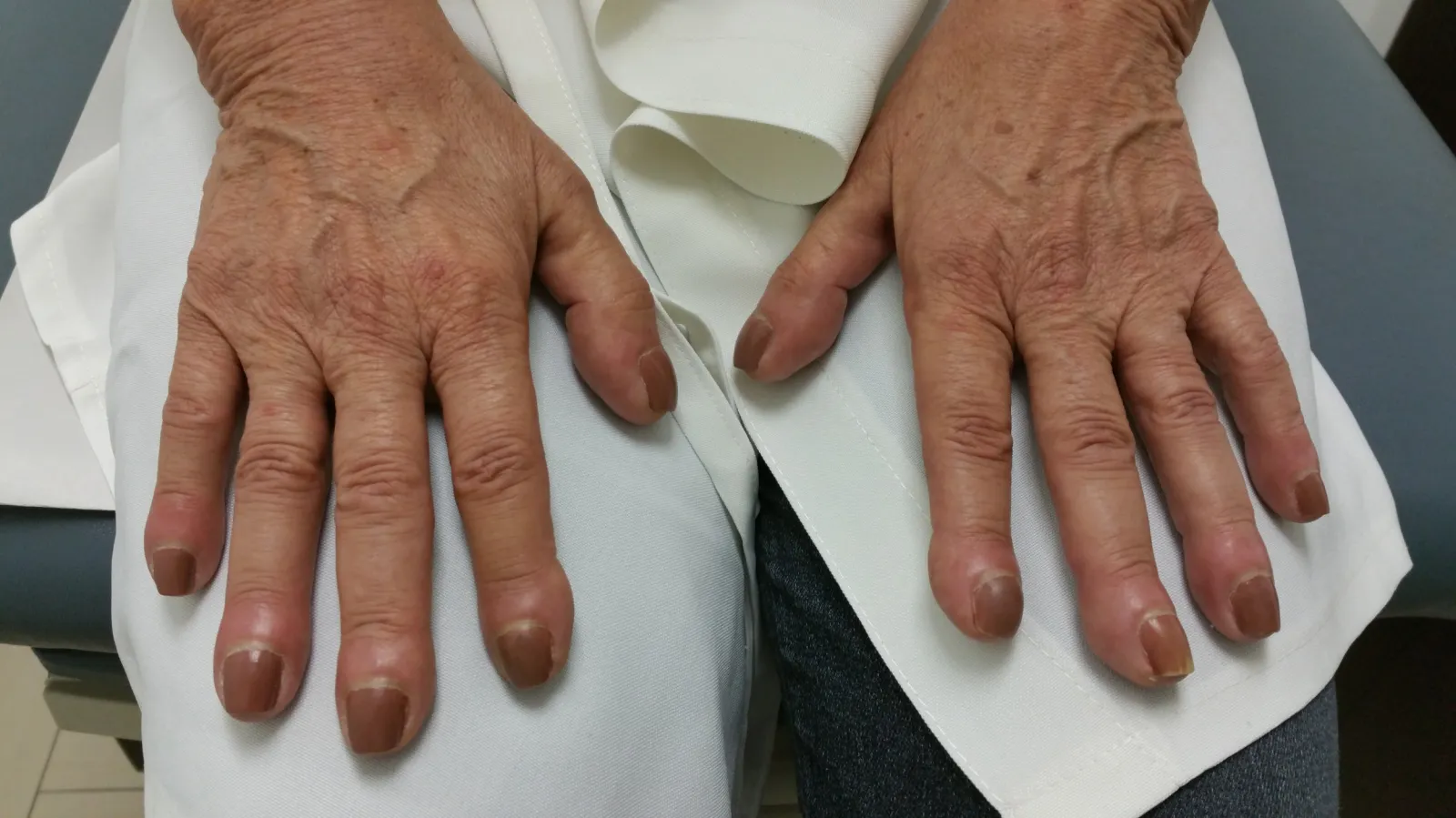 This Simple Finger Test Could Reveal Signs of Lung Cancer and Other ...