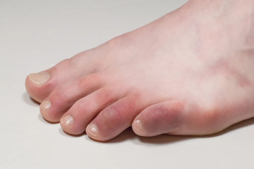 13-year-old Struggles to Walk After Having COVID Toes for Nine Months ...