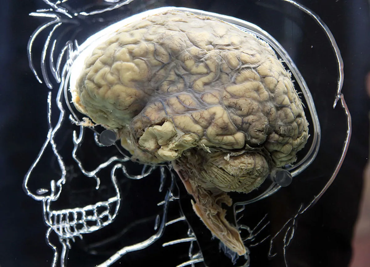 Stroke of Genius: Electric Brain Shocks Could Help Stroke Victims ...