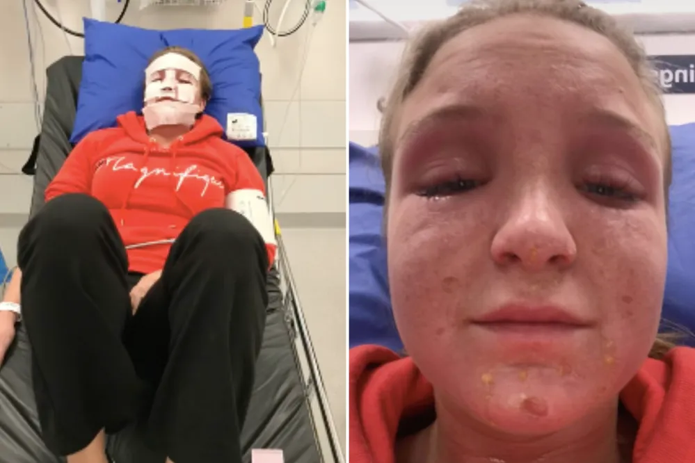 Woman Issues Warning After Facial Burns Caused by 18-Minute Tanning ...