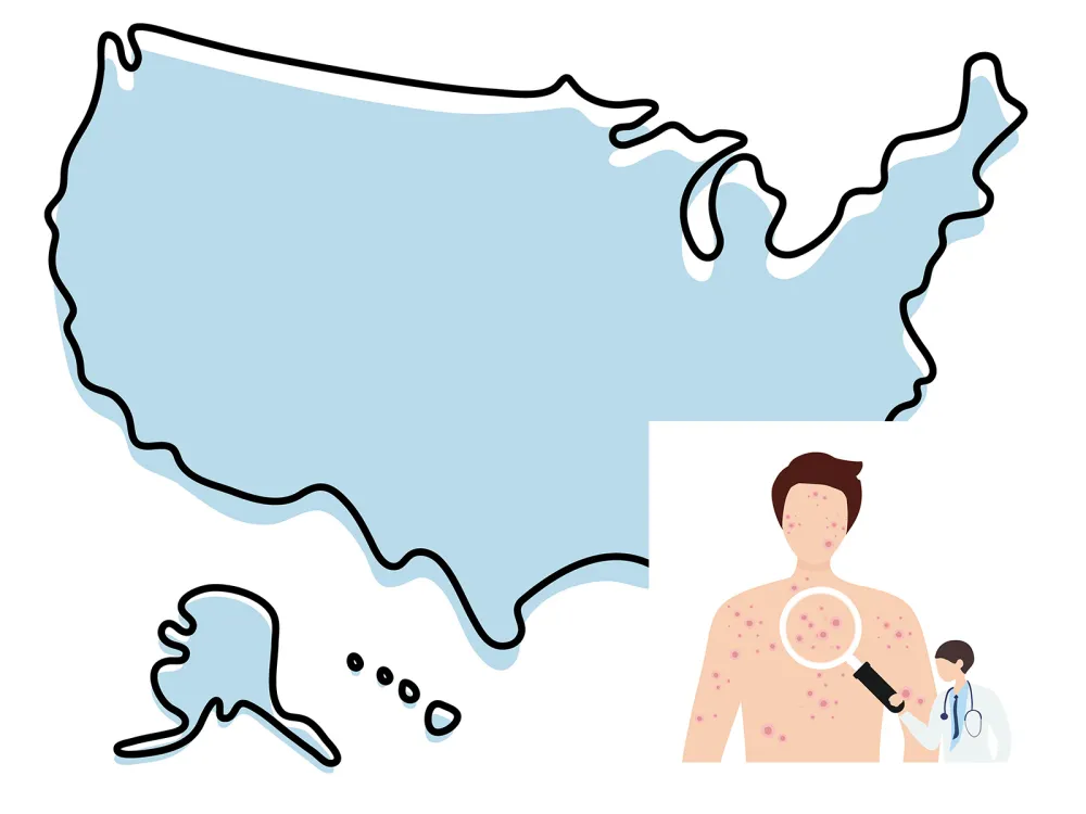 Extremely Mutated Monkeypox Strain Appears to Have a Single Point of ...