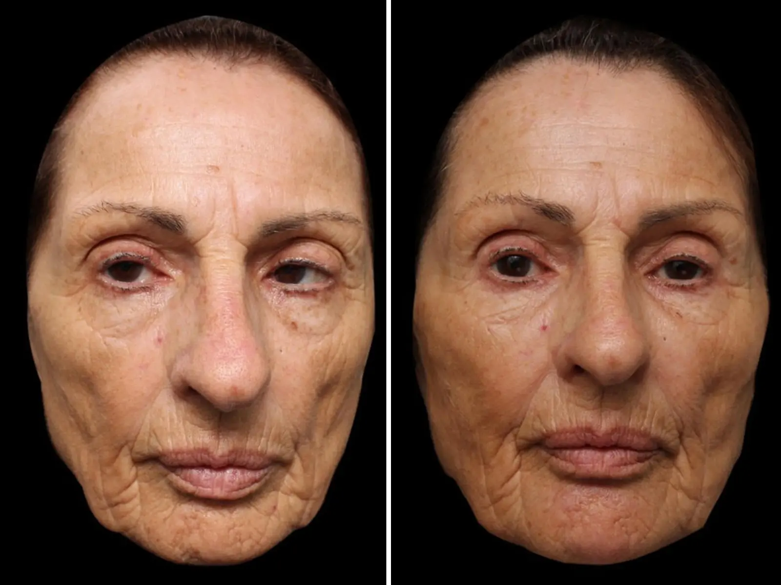 The New ‘Revolutionary’ Rejuvenation Procedure That Can Transform Your ...