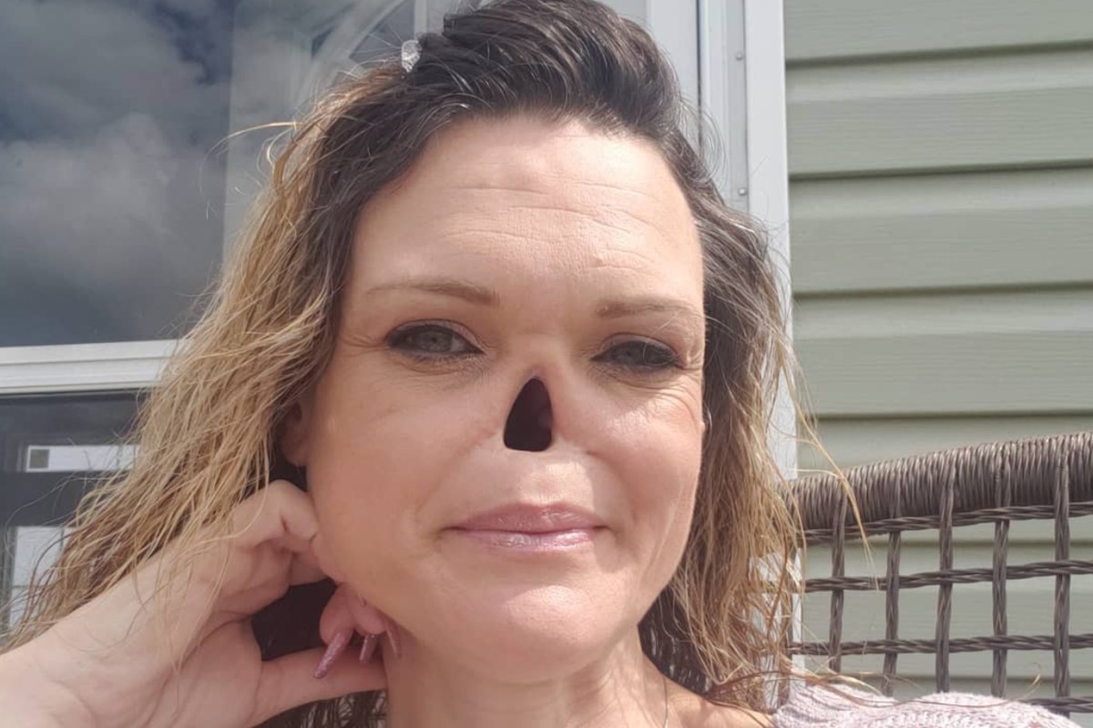 ‘I Almost Lost My Life, But I Chose To Cut Off My Nose Instead’ - Newsweek