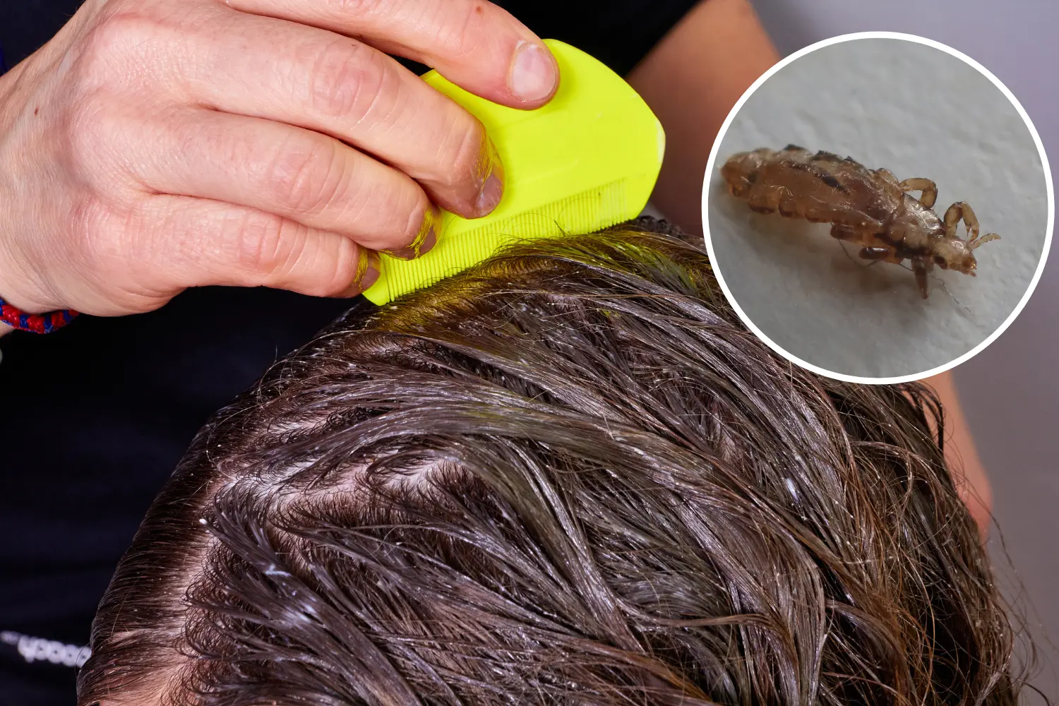 Inside Job of a Professional Head Lice Remover: ‘I Make About $500 per ...