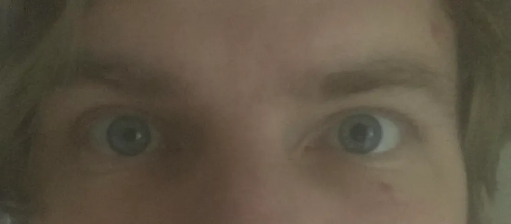 Man Who Ignored ‘Wonky’ Pupils Diagnosed With Brain Tumor - Newsweek