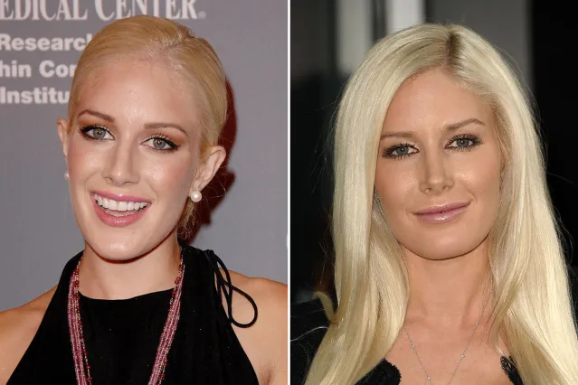 Heidi Montag Plastic Surgery Before and After Photos: Why She Almost ...