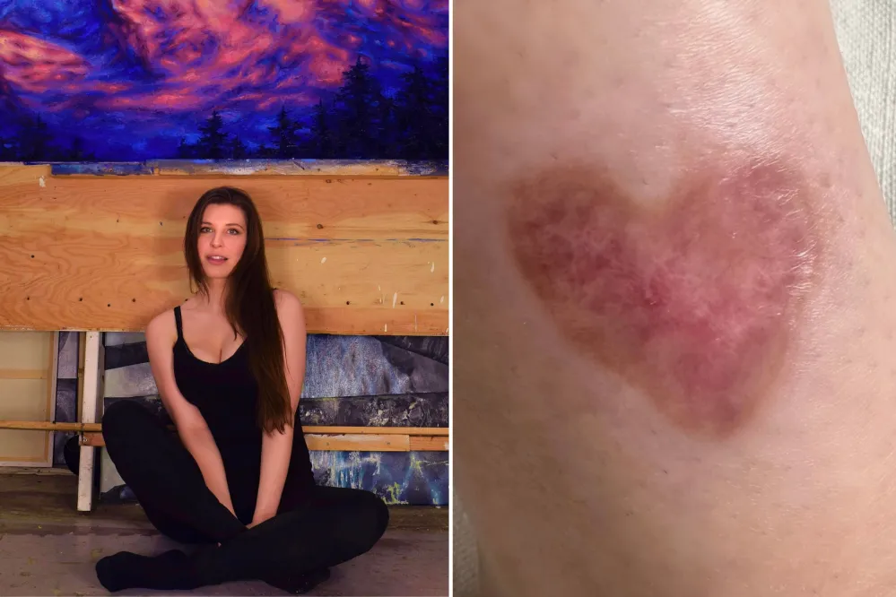 Woman Stunned When Rare Flesh-Eating Spider Bite Turns Into the ...