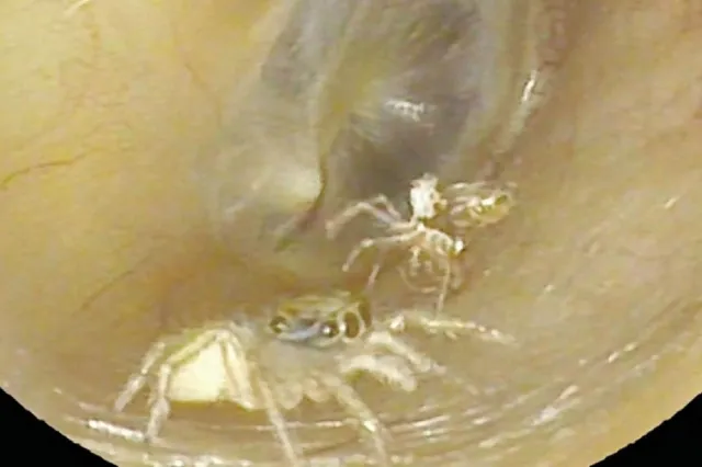 Spider Found Shedding Its Exoskeleton Inside Woman’s Ear - Newsweek