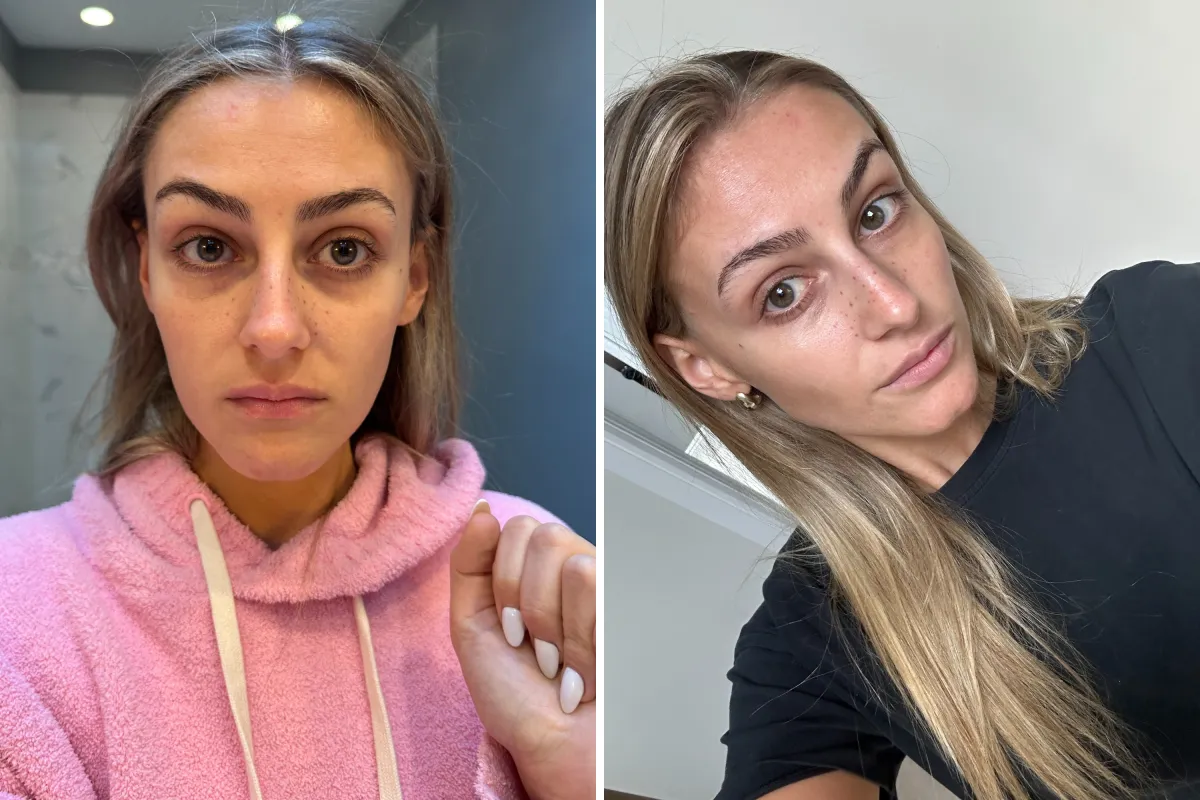 Woman Shares How Skin Looks 2 Weeks After Quitting Sugar, Processed ...