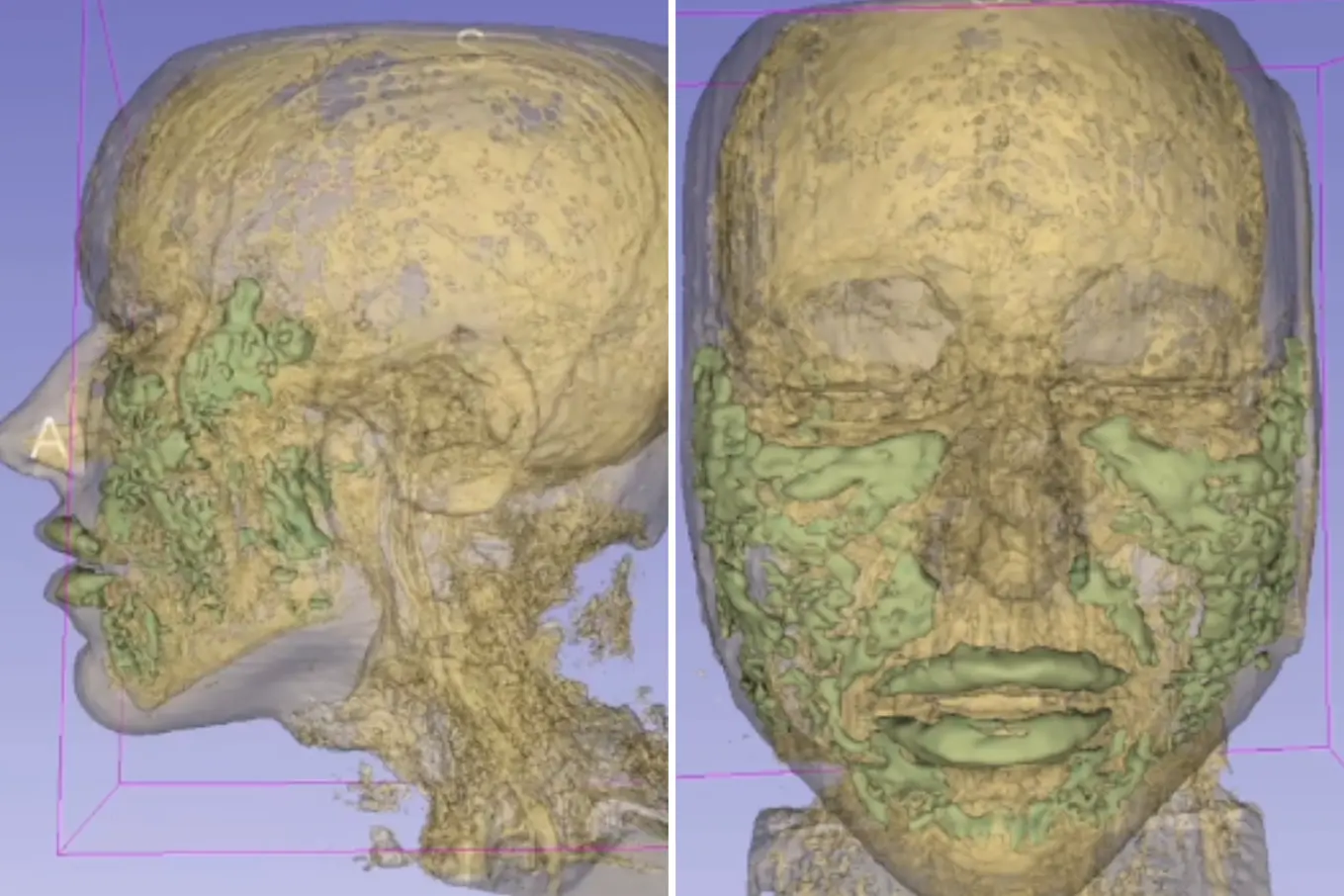 MRI of 33-Year-Old Woman’s Face Shows Exactly Where Her Filler Ended Up ...