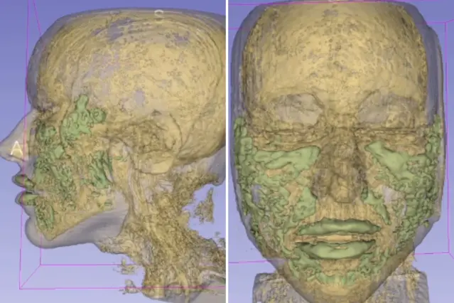 MRI of 33-Year-Old Woman’s Face Shows Exactly Where Her Filler Ended Up ...
