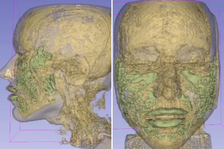 MRI of 33-Year-Old Woman’s Face Shows Exactly Where Her Filler Ended Up ...