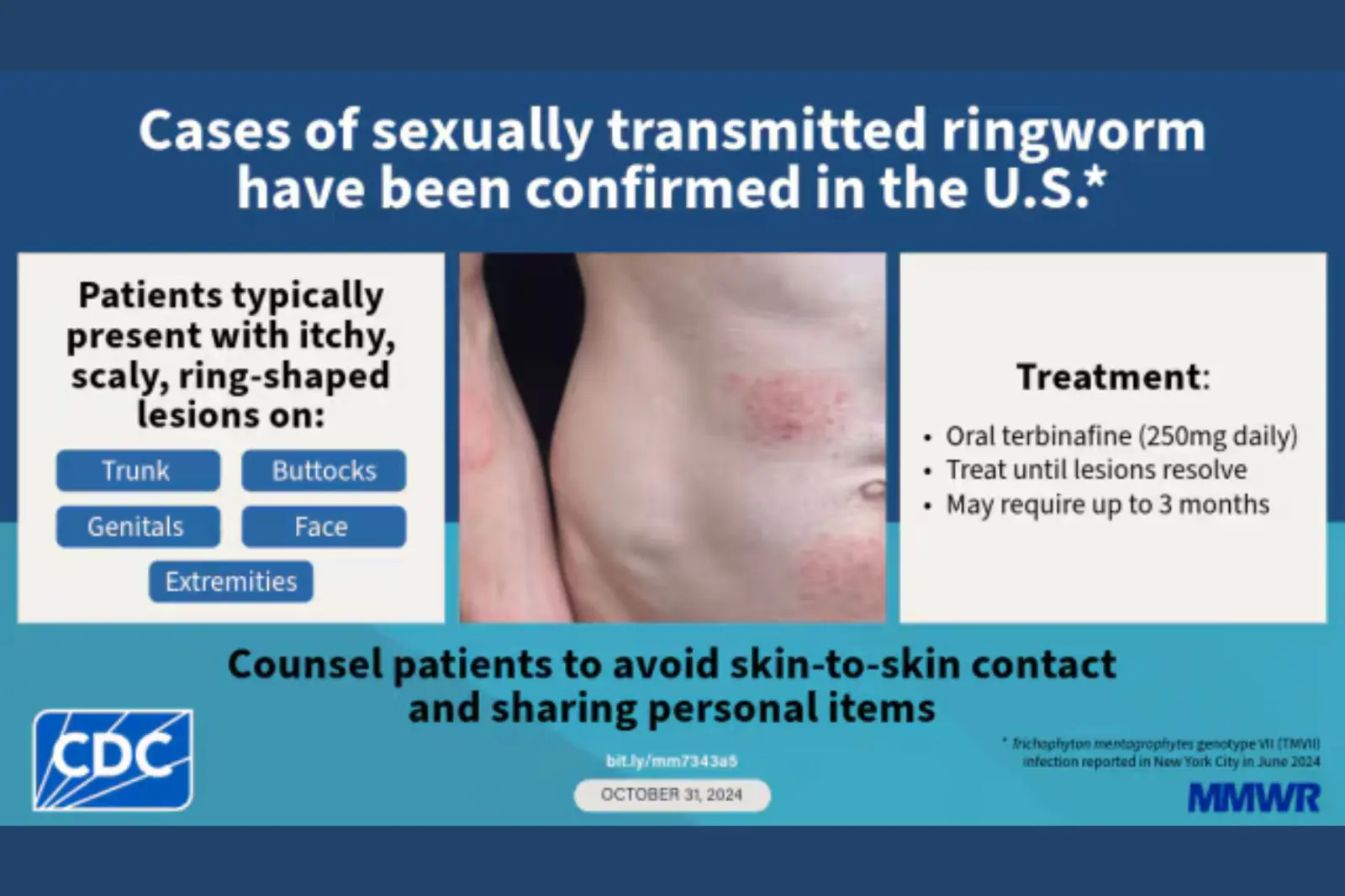 CDC Warning Over Genital Fungus ‘Emerging’ in New York City - Newsweek