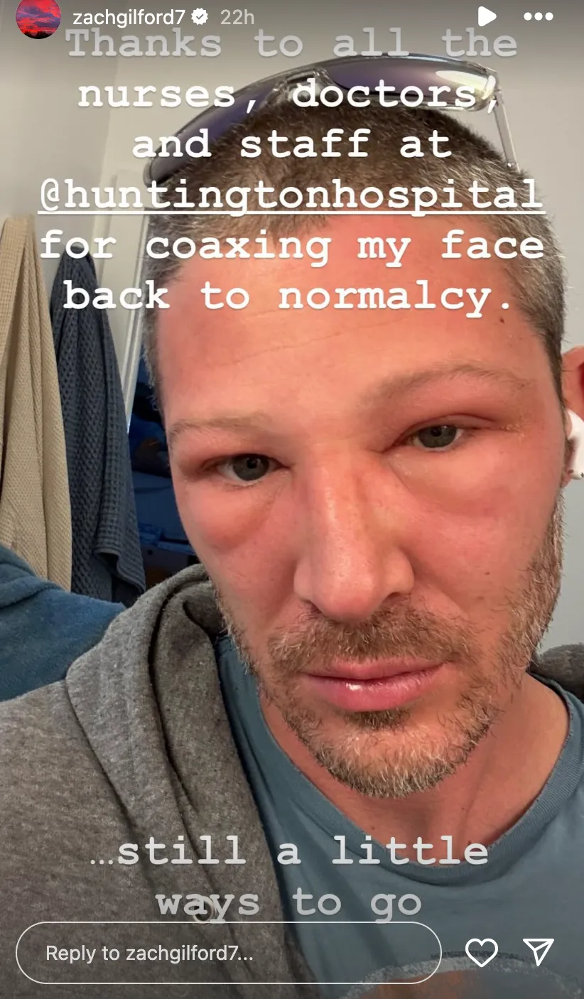 Zach Gilford Shares Shocking Photo Of His Face - Newsweek