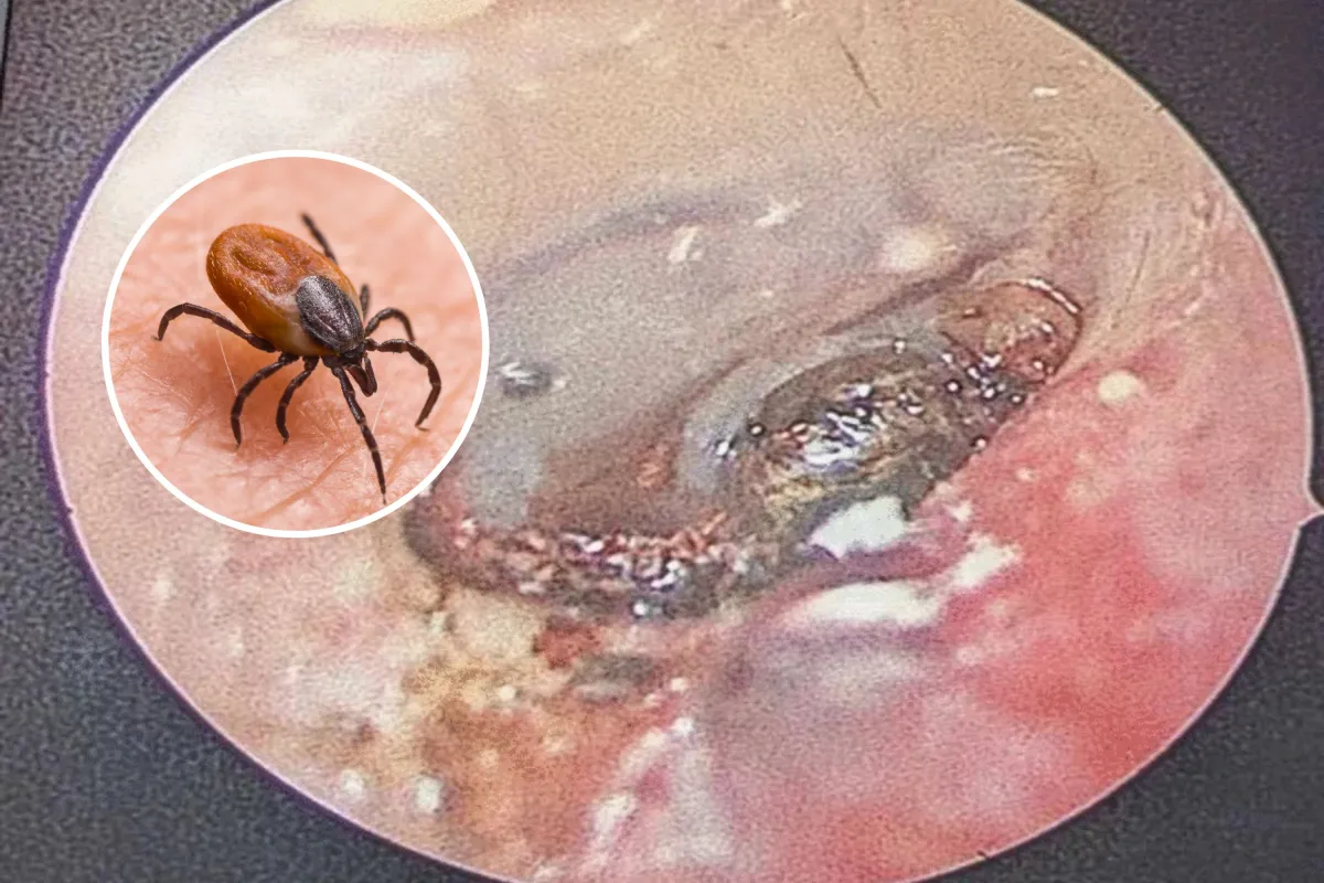 Tick Stuck in Woman's Ear Causes 'Piercing' Pain and Deafness - Newsweek