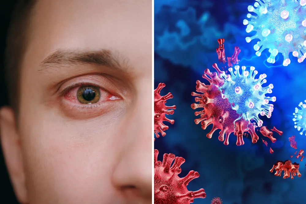 Bird Flu Symptoms To Watch For in 2025 As Virus Mutates - Newsweek