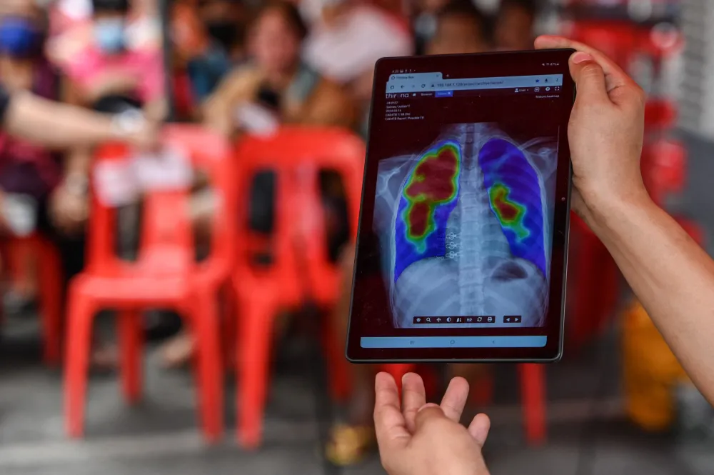 Tuberculosis News & Latest Pictures From Newsweek.com