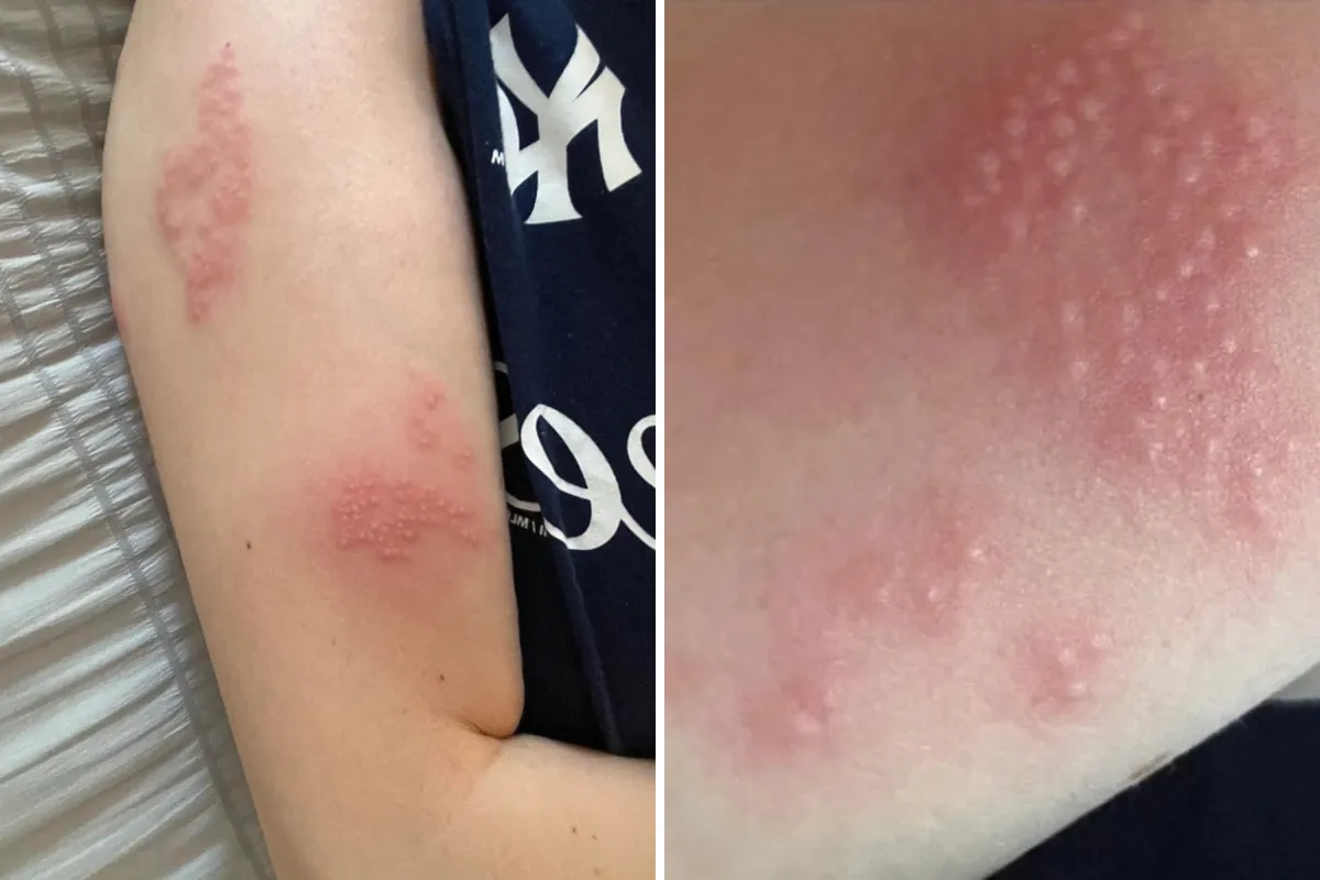 Gen Z Woman Sees Rash on Arm After Swimming in Pool, Then Comes ...