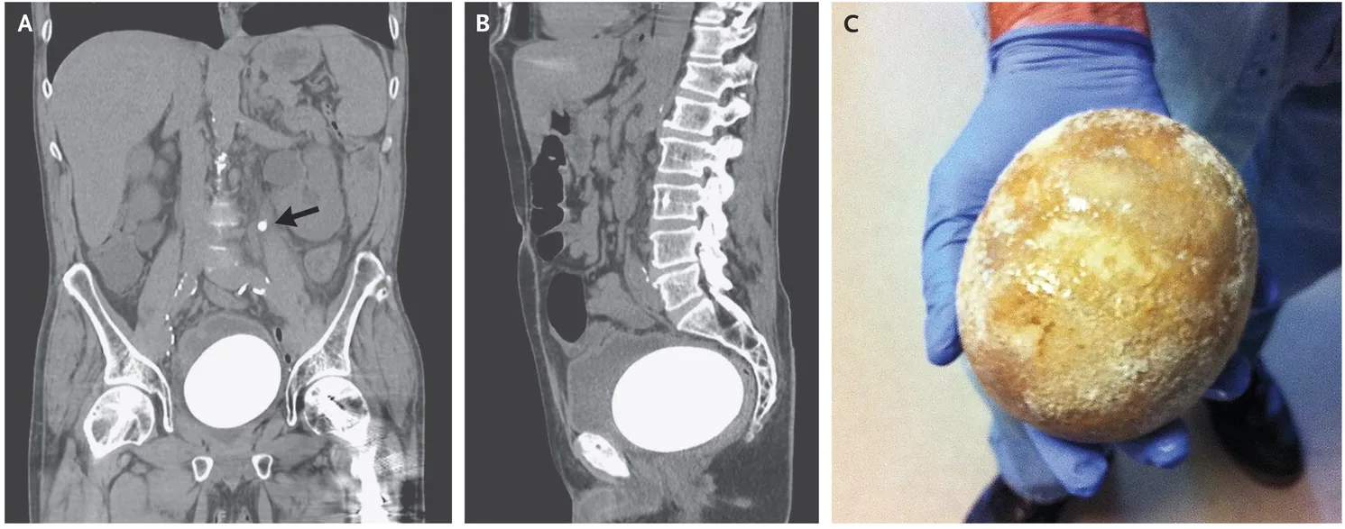 A Rare Case of Large Bladder Stone: Diagnosis, Surgical Approach, and ...
