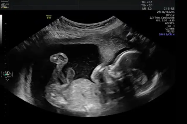 Pregnant Woman Asked How 20-Week Anatomy Scan Went, Video Says It All ...