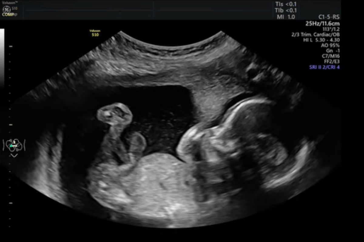 Pregnant Woman Asked How 20-Week Anatomy Scan Went, Video Says It All ...