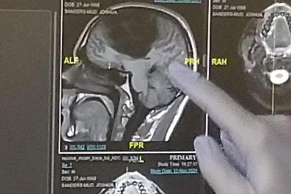 I Had a Seizure at 23—Then Surgeons Removed a Third of My Brain - Newsweek