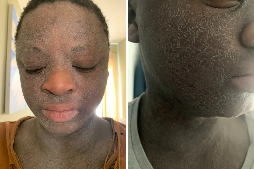 Woman Given Steroids as a Child—Now Faces Agonizing Condition - Newsweek