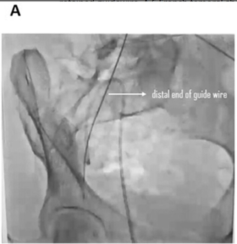 Woman Felt Fine Months After Procedure—X-Ray Reveals Object Left Inside ...