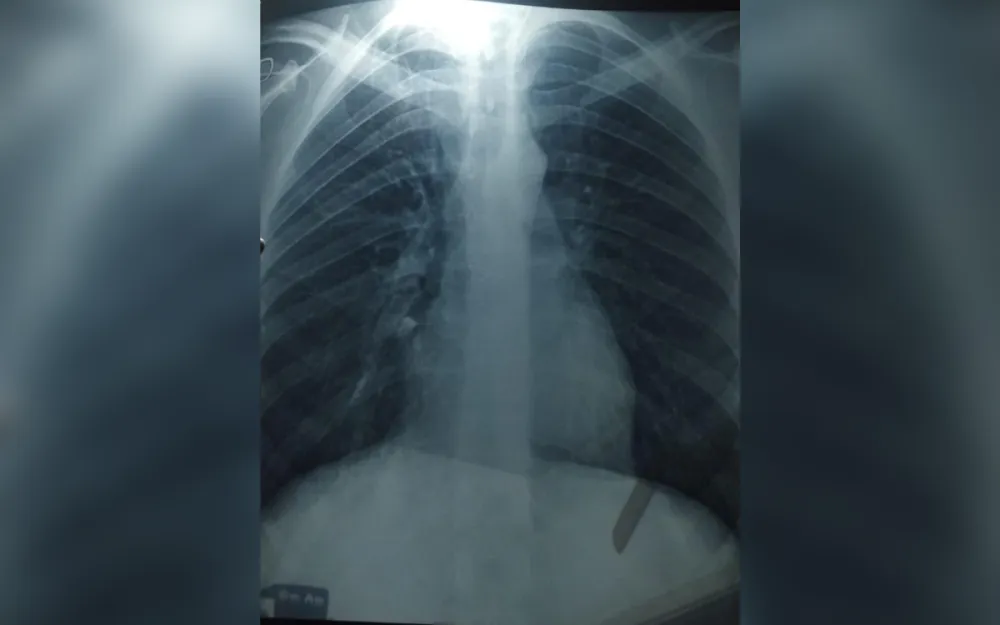 Man Gets X-Ray After ‘Weird Hiccups’ Begin—Then Doctors Spot the ...